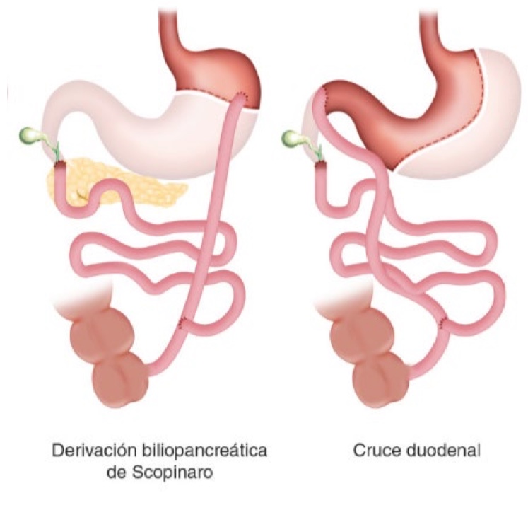 Reducción de estómago | Carácteristicas y comparación