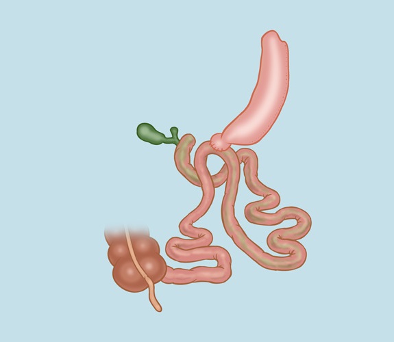 Bypass Gástrico (en Y de Roux) y Bypass SADIS